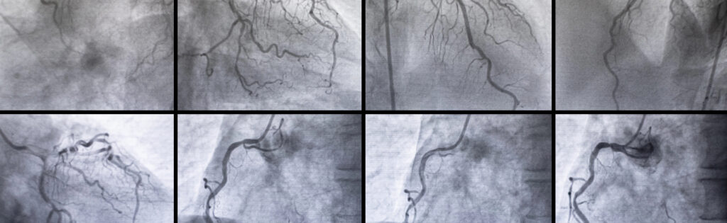 Preparing for Your Coronary Angiogram: Tips and Checklist