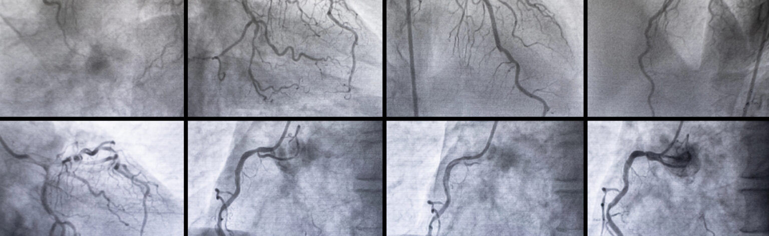 Preparing for Your Coronary Angiogram: Tips and Checklist